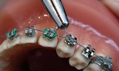 Brackets metálicos - Málaga | Clínicas Rincón Dental Brackets metálicos - Málaga | Clínicas Rincón Dental