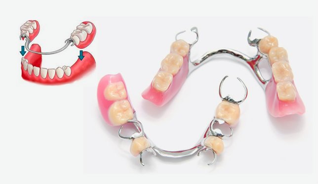 Prótesis removibles - Málaga | Clínicas Rincón Dental